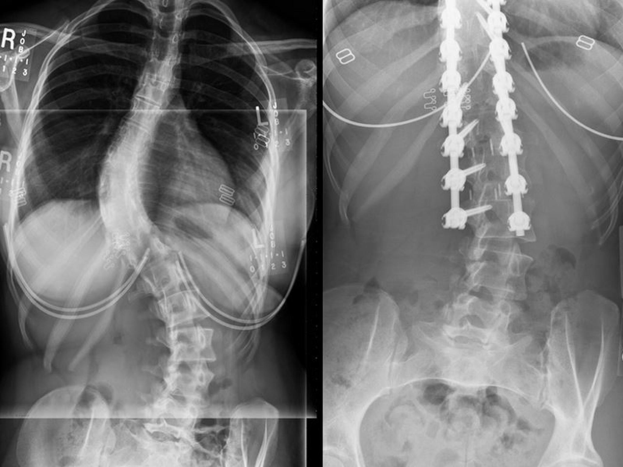 Skoliose: Leben mit einer krummen Wirbelsäule